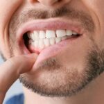 How to Treat Tooth Decay at the Gum Line | Stains vs Cavities
